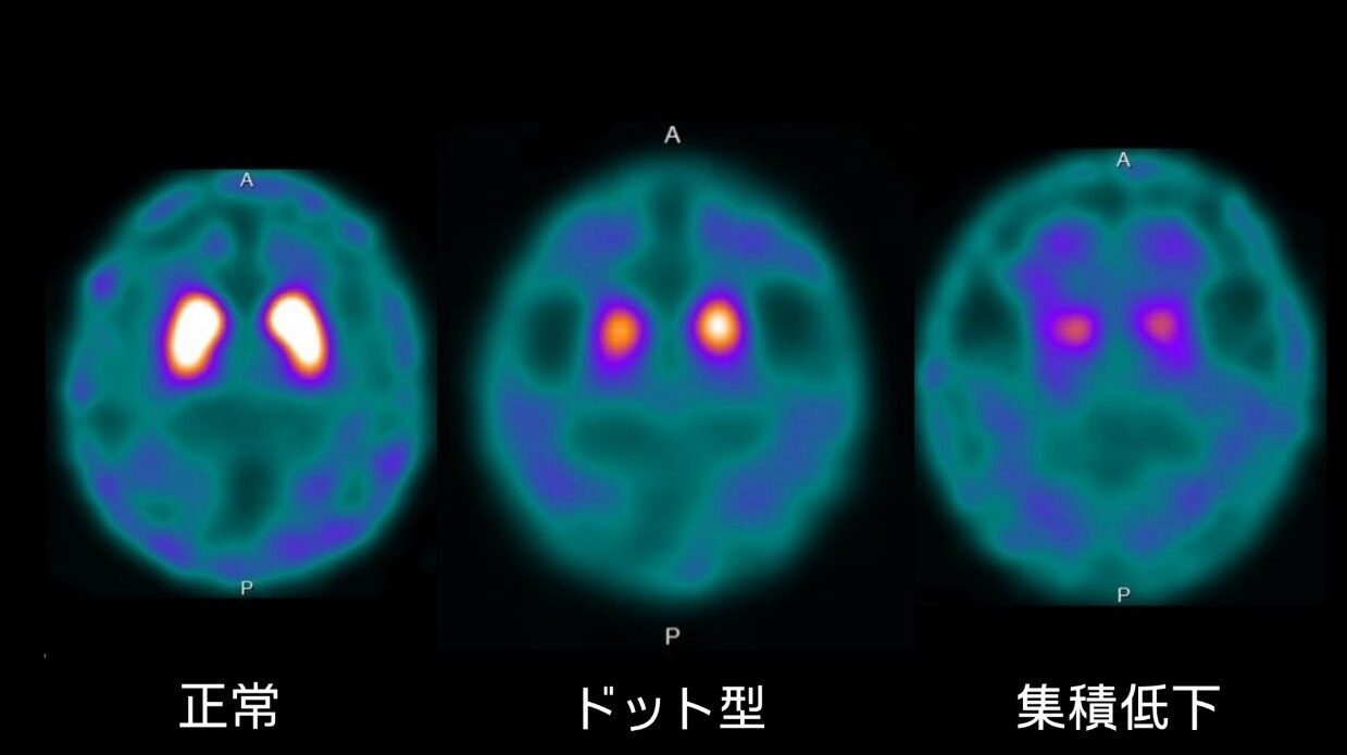 DATスキャンとは | News一覧| 大田区蒲田 牧田総合病院 | 社会医療法人財団 仁医会
